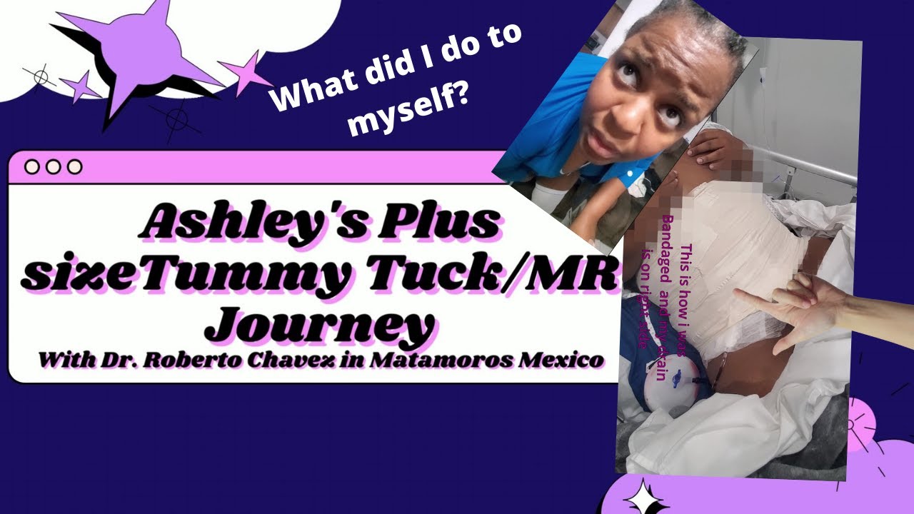 Plus Size Extended Tummy Tuck Video 3 (Day of Surgery and day 1/2 post ...