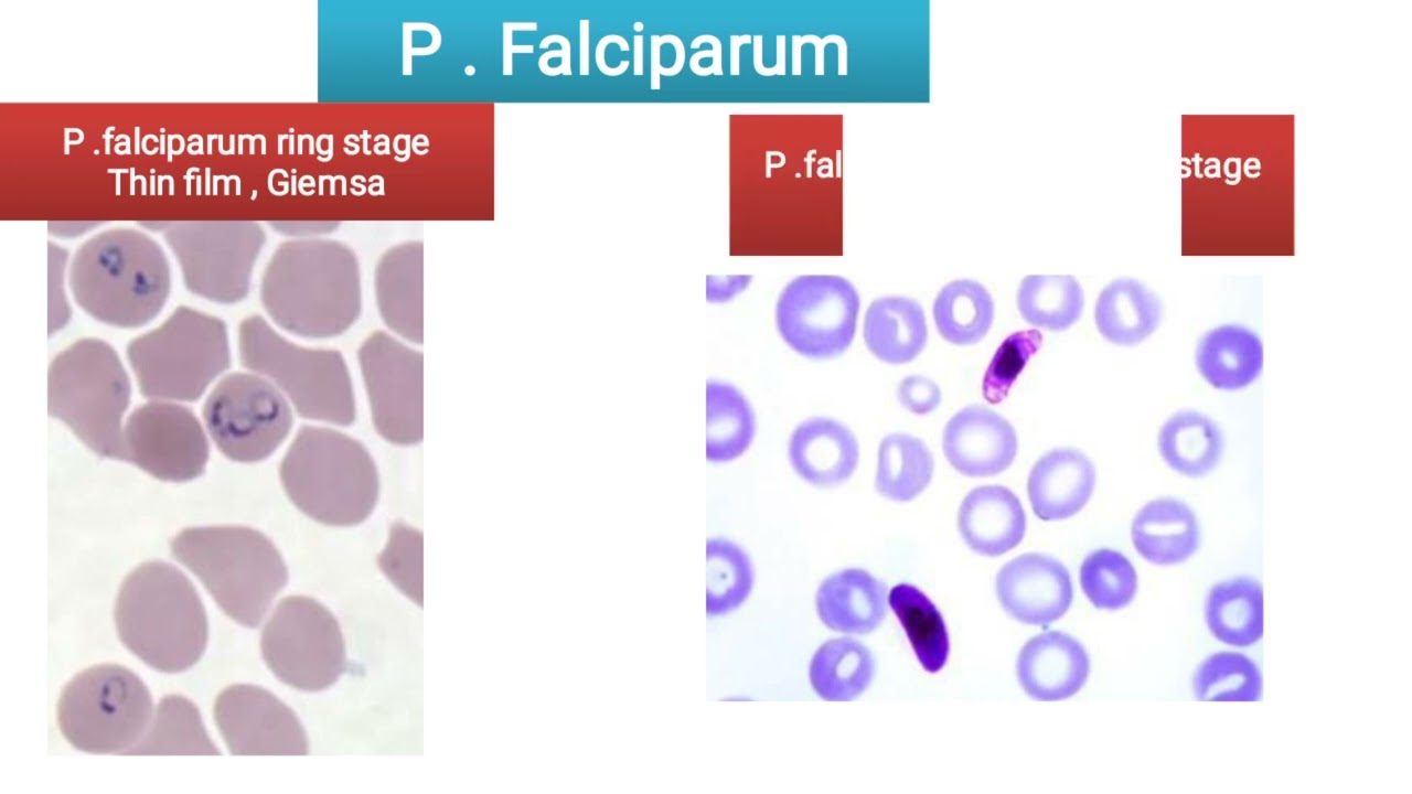 Haematology module practical (2) malaria and babesia - YouTube