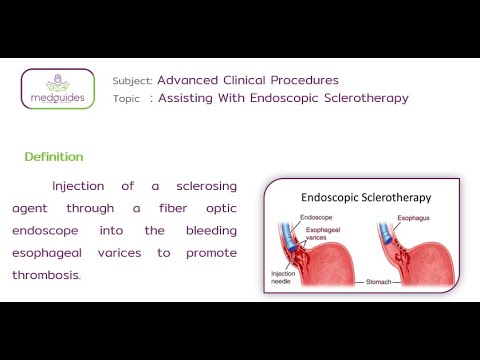 26.Assisting With Endoscopic Sclerotherapy - YouTube