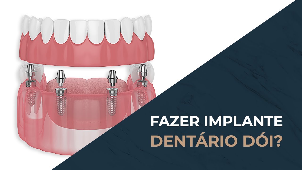 Colocar Implante Dentário Dói? Entenda a cirurgia e todo o processo ...