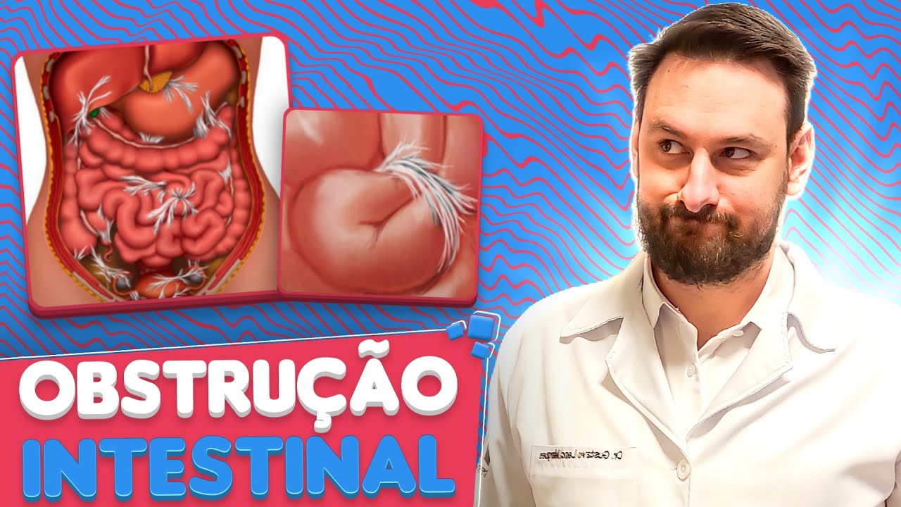 Médico explica o que é a OBSTRUÇÃO INTESTINAL! SINTOMAS E TRATAMENTO ...