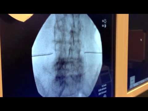 Watch This Bilateral Transforaminal Injection Live by Dr. McJunkin ...