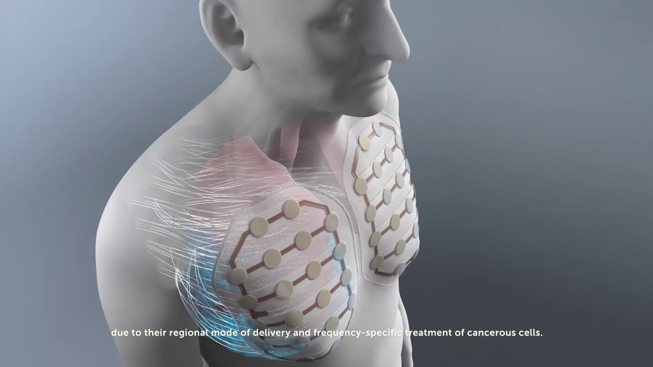 MOA for Optune Lua (full) - YouTube