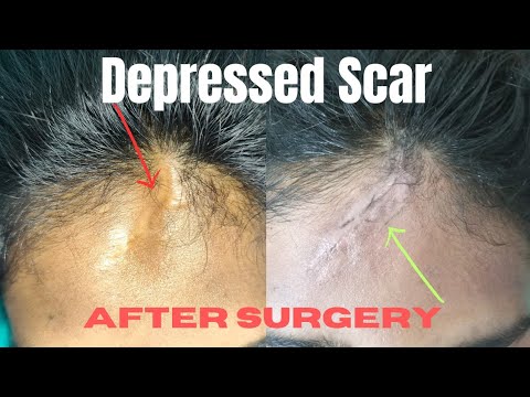 Depressed scar on forehead - Change after surgery| Best Scar revision ...