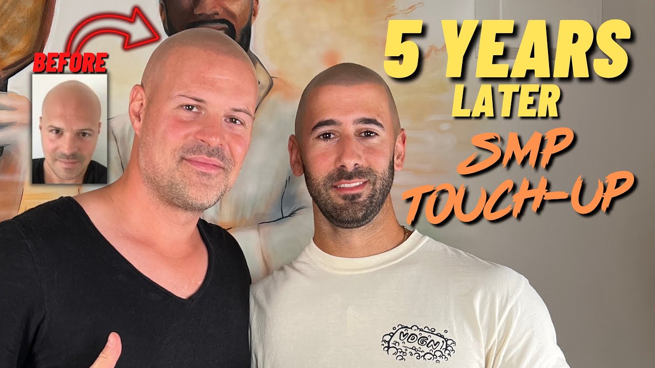 5 YEARS LATER w/ Scalp Micropigmentation - YouTube