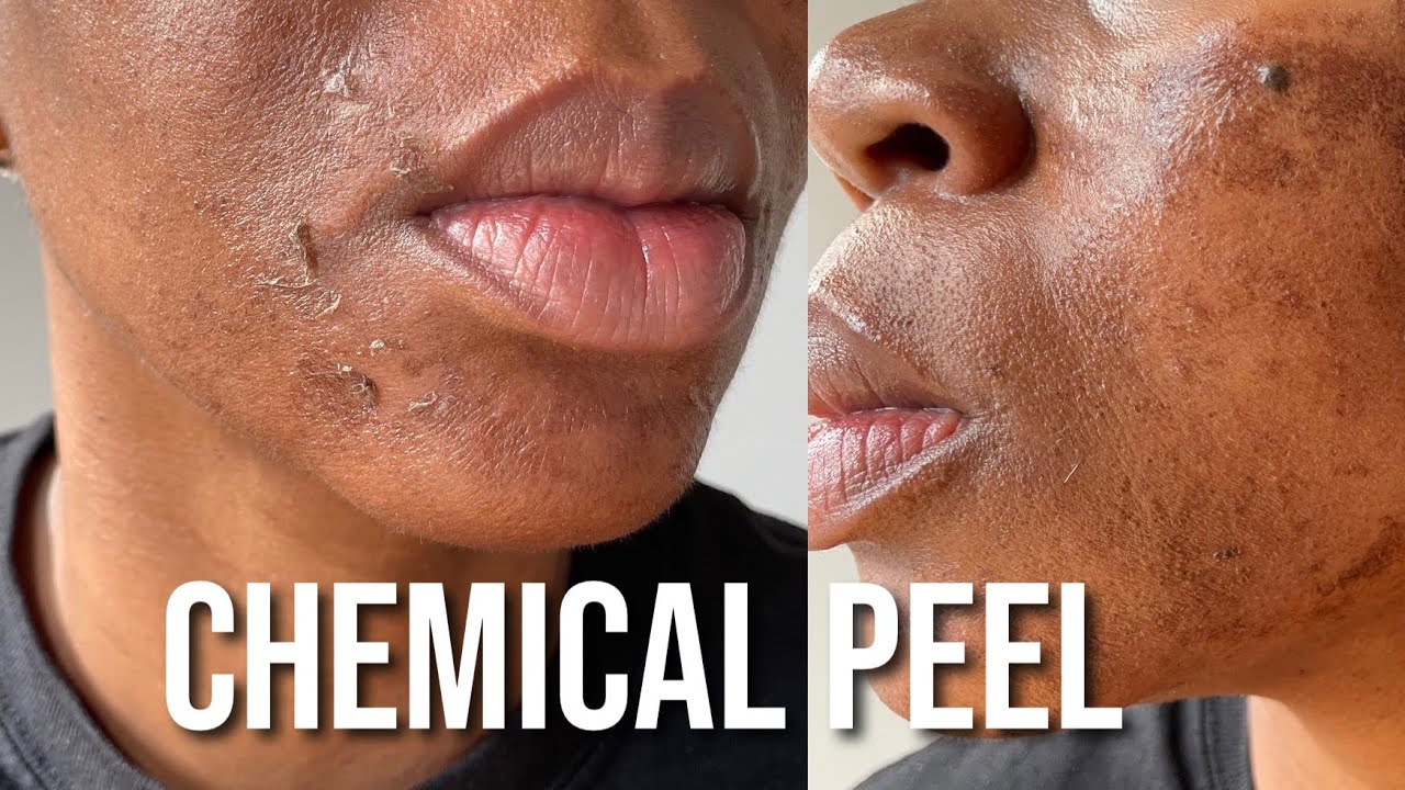 TCA Chemical Peel on Dark Skin for Hyperpigmentation and Texture - YouTube