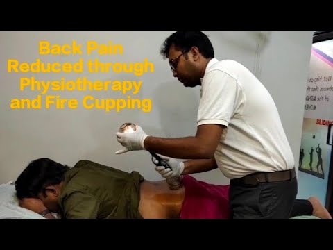 Fire Cupping Therapy to treat Low Back Pain. Immediate Back Pain Relief ...