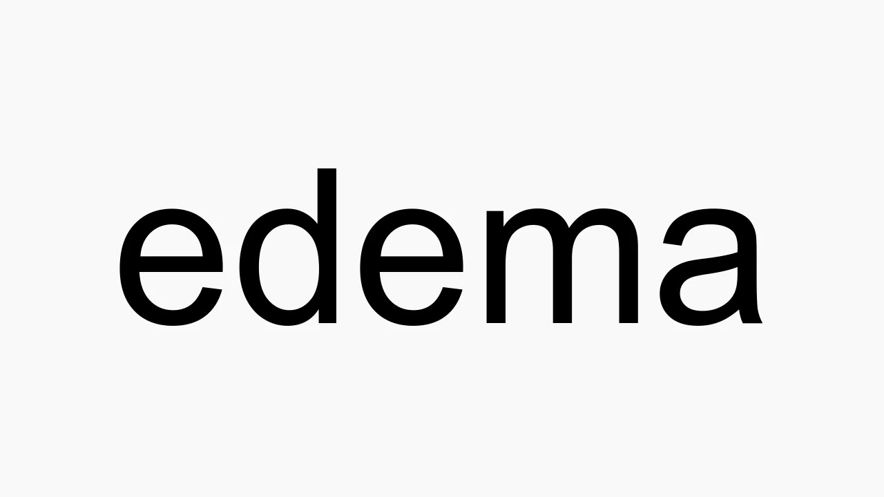 How to pronounce edema - YouTube