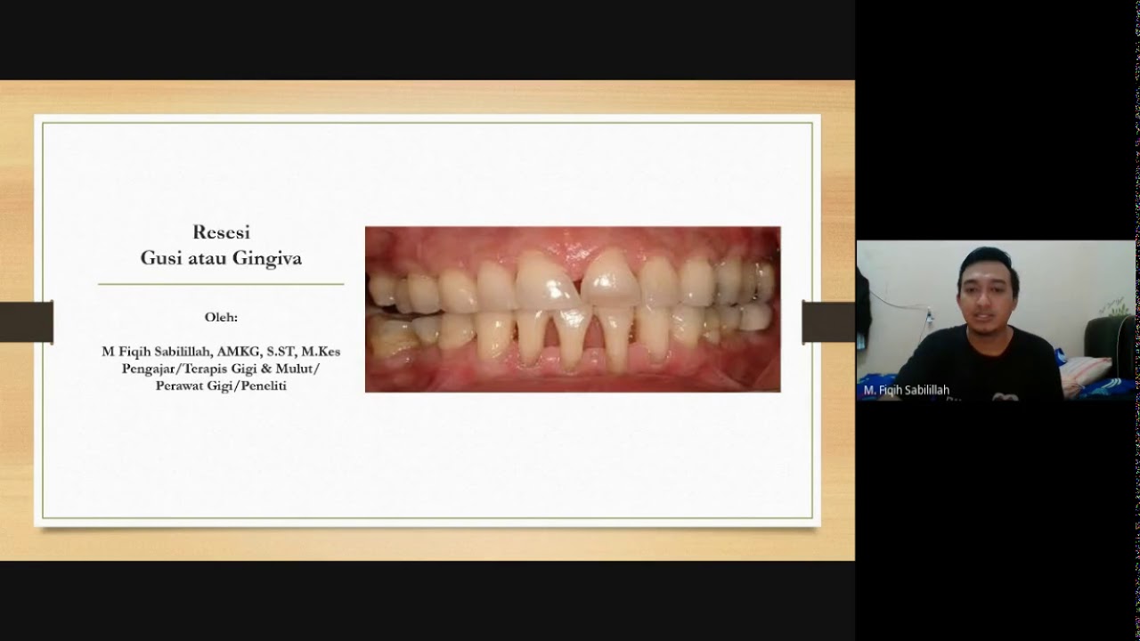 Materi #3 : Resesi Gingiva atau Gusi Turun #Edukasi - YouTube