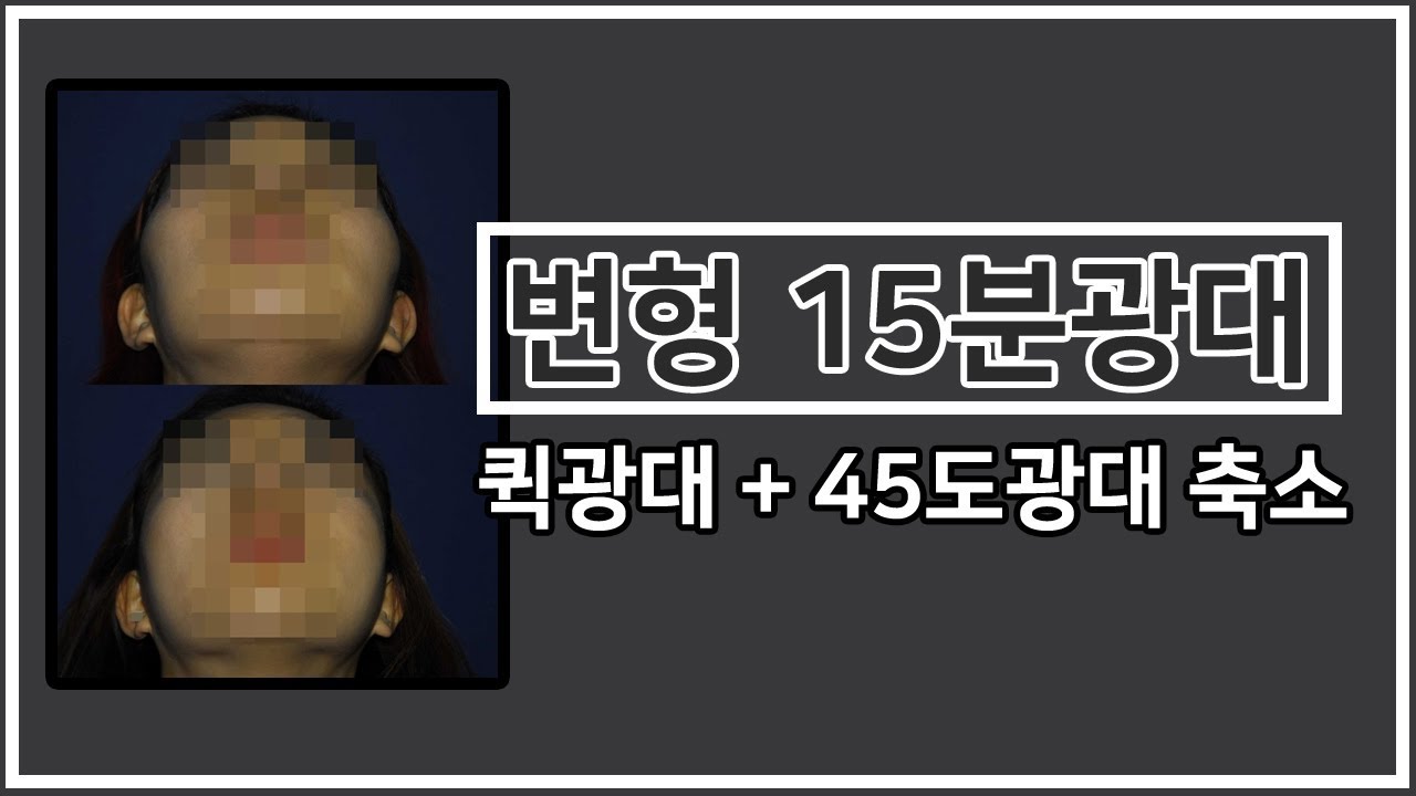 변형15분광대축소술 Type.A 전후사진(reduction malarplasty/cheekbone reduction/quick ...