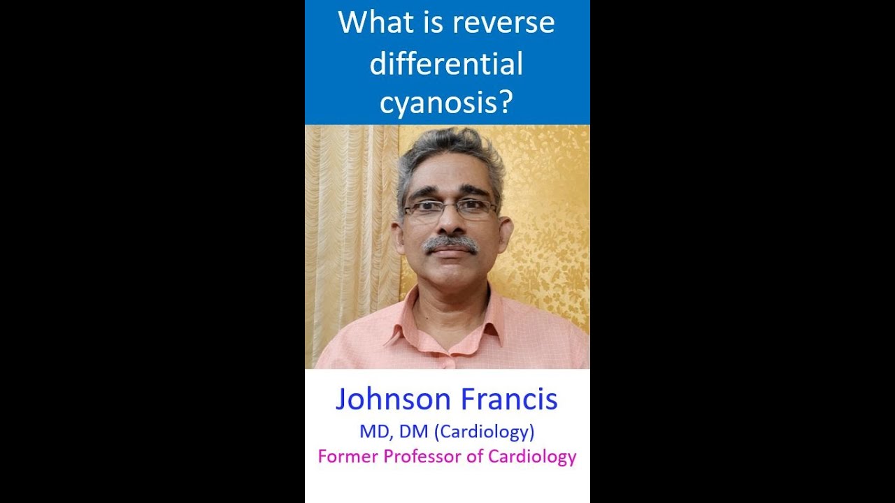 What is reverse differential cyanosis? - YouTube