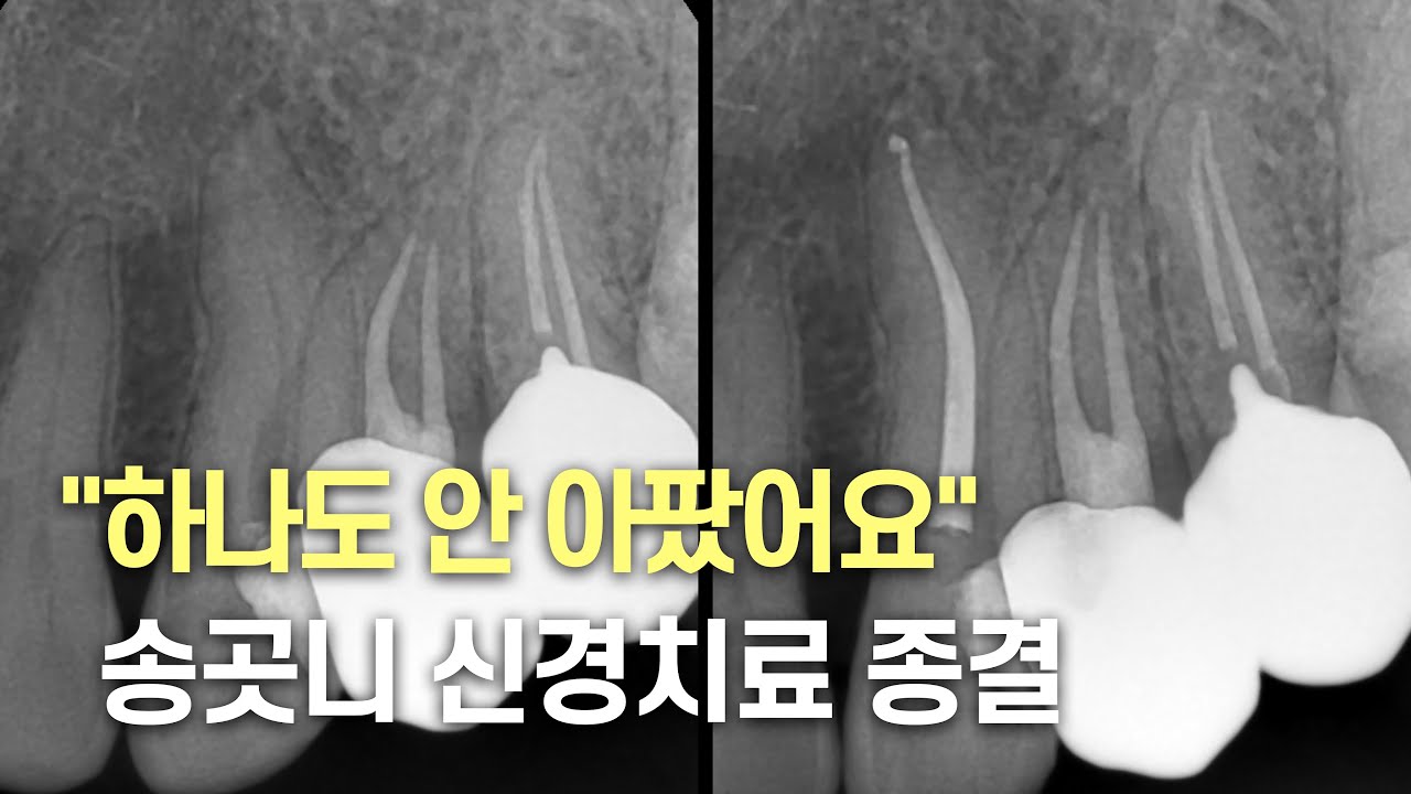 #23 Mx. Canine Obturation & Core - YouTube