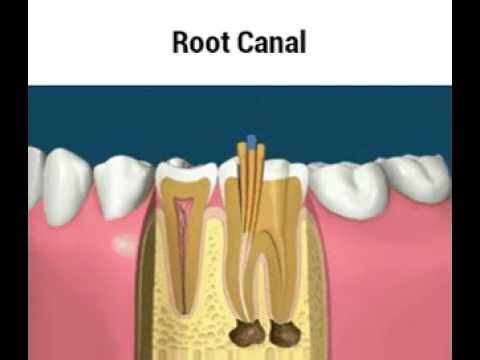 CROWN AND RCT Animation - YouTube