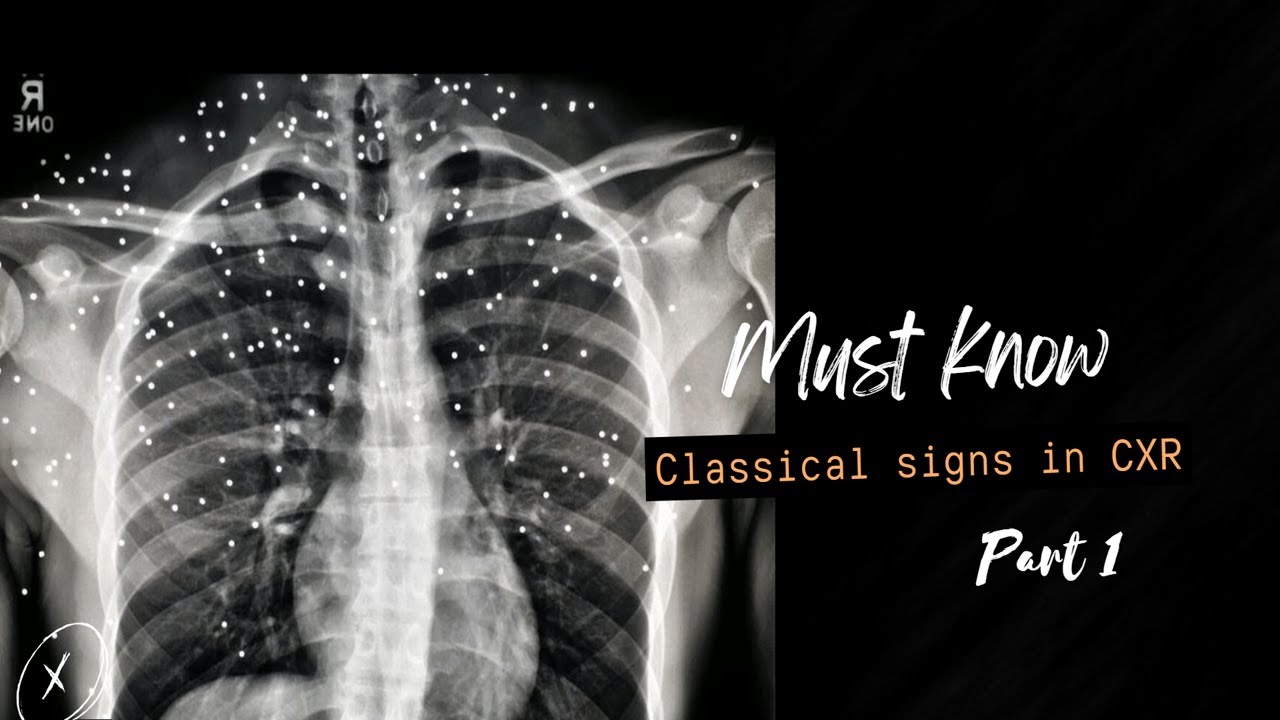 Classical signs in CXR - Must know - YouTube