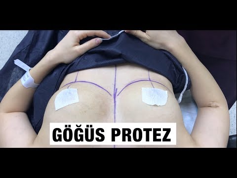 Göğüs Protez Seçimi