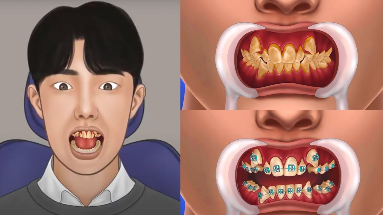 ASMR 리얼함 주의! 신기한 치아교정 애니메이션 | 치아 발치 | 덧니 | Amazing braces animation ...