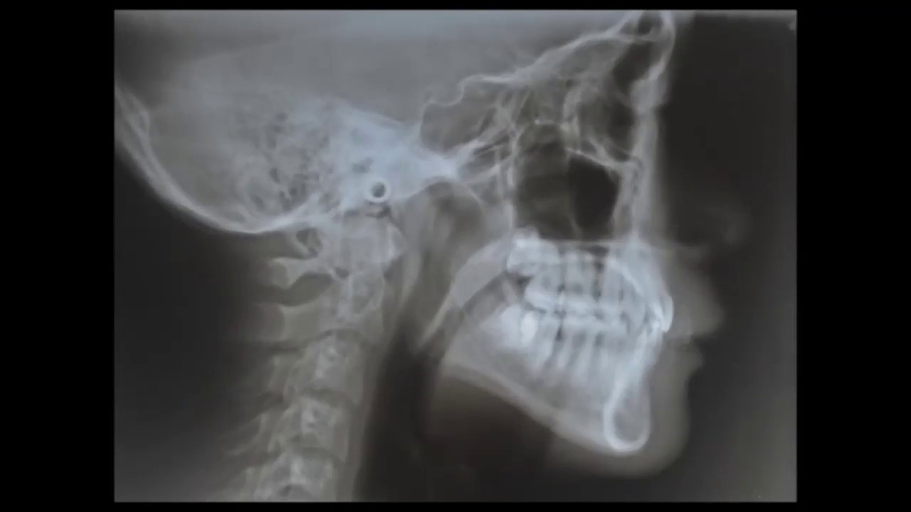 Tweed Triangle, Angle's class Ⅱ malocclusion and facial profile changes ...