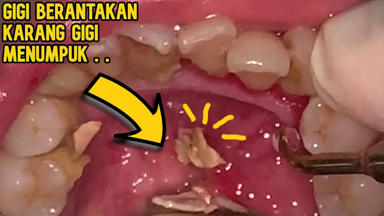 Karang Gigi Menumpuk Akibat Susunan Gigi Tidak Rapih | Dokter Gigi Tri ...
