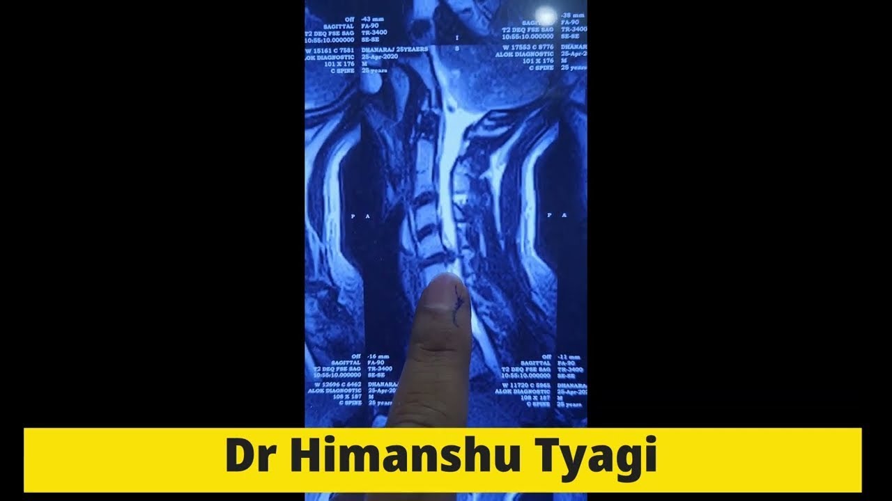 Cervical disc Replacement Surgery- Happy Patient (ADR/ Cervical ADR ...