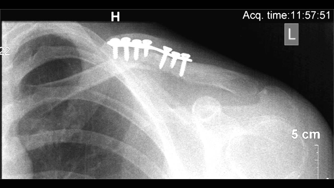 Bone Break SOUND Effects - YouTube