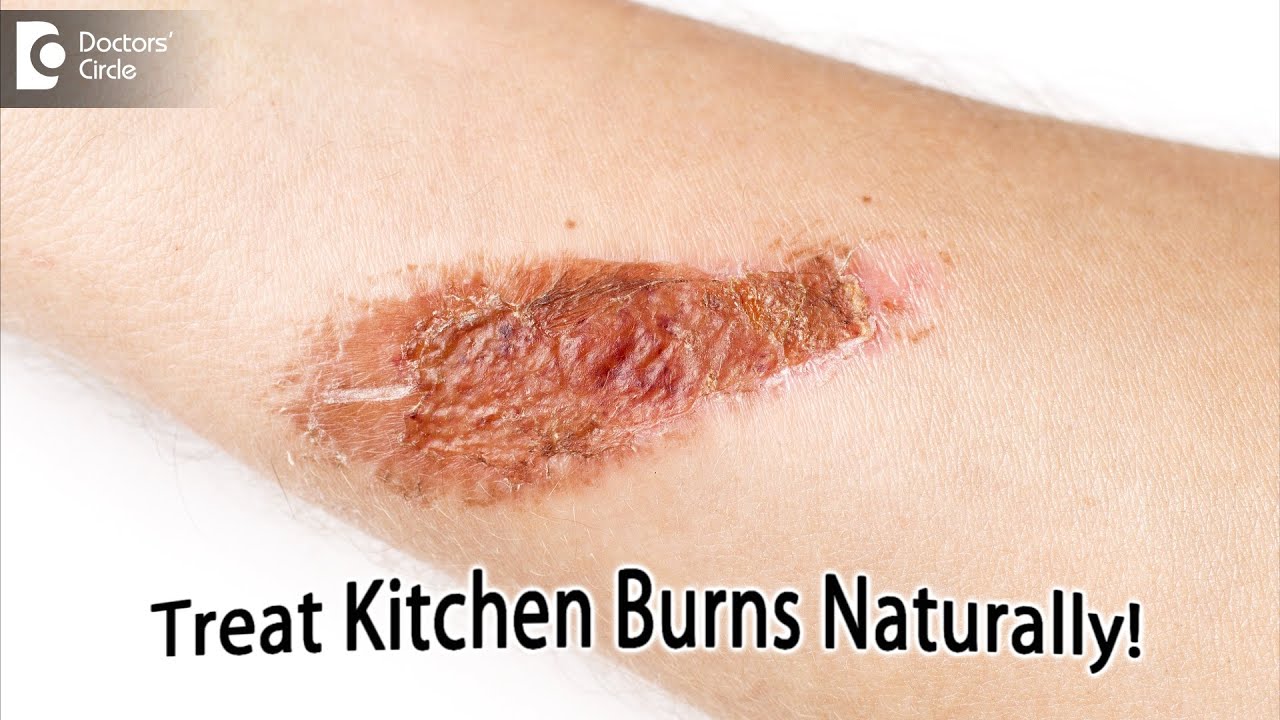 Emergency Tips to mange Skin burn while cooking | FIRST AID - Dr ...