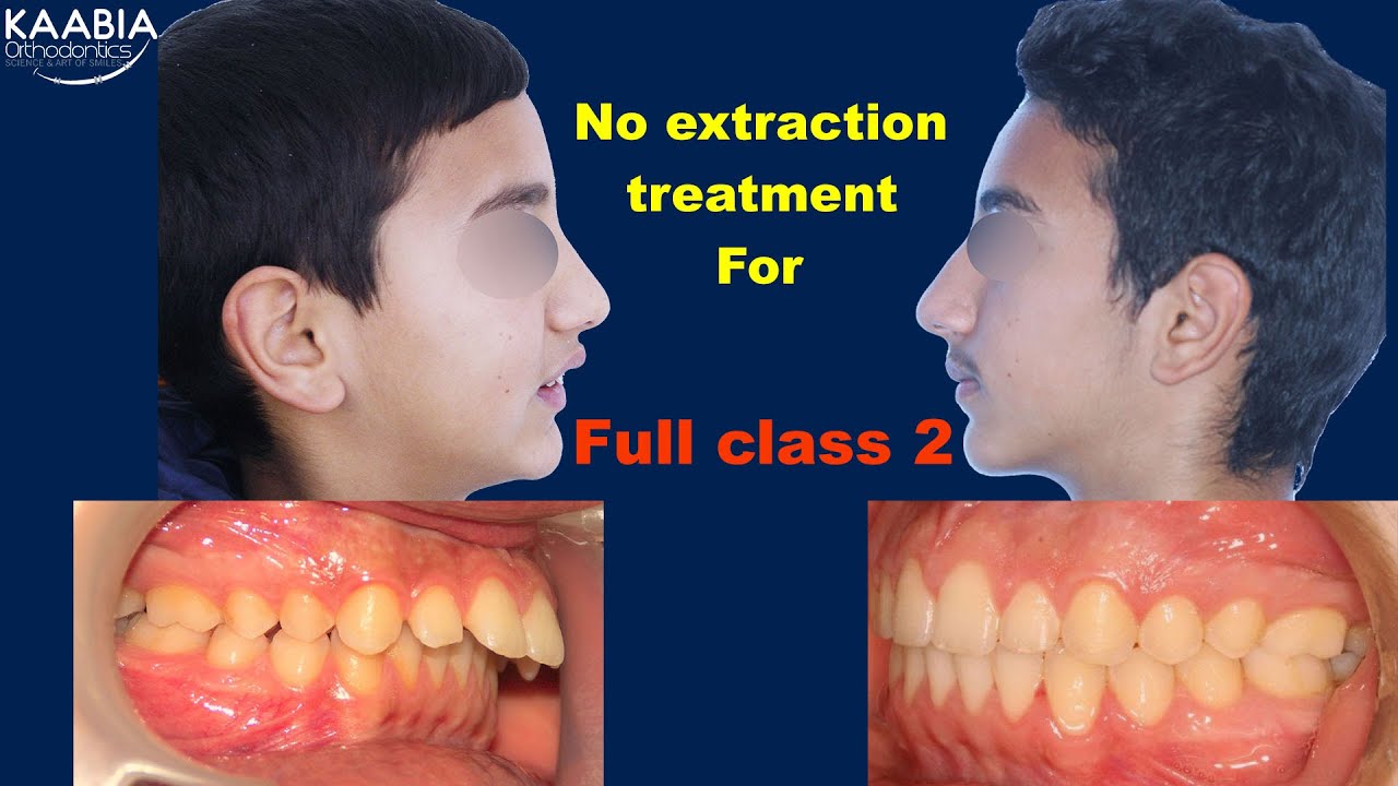 No extraction treatment of full class 2 malocclusion with Damon system ...