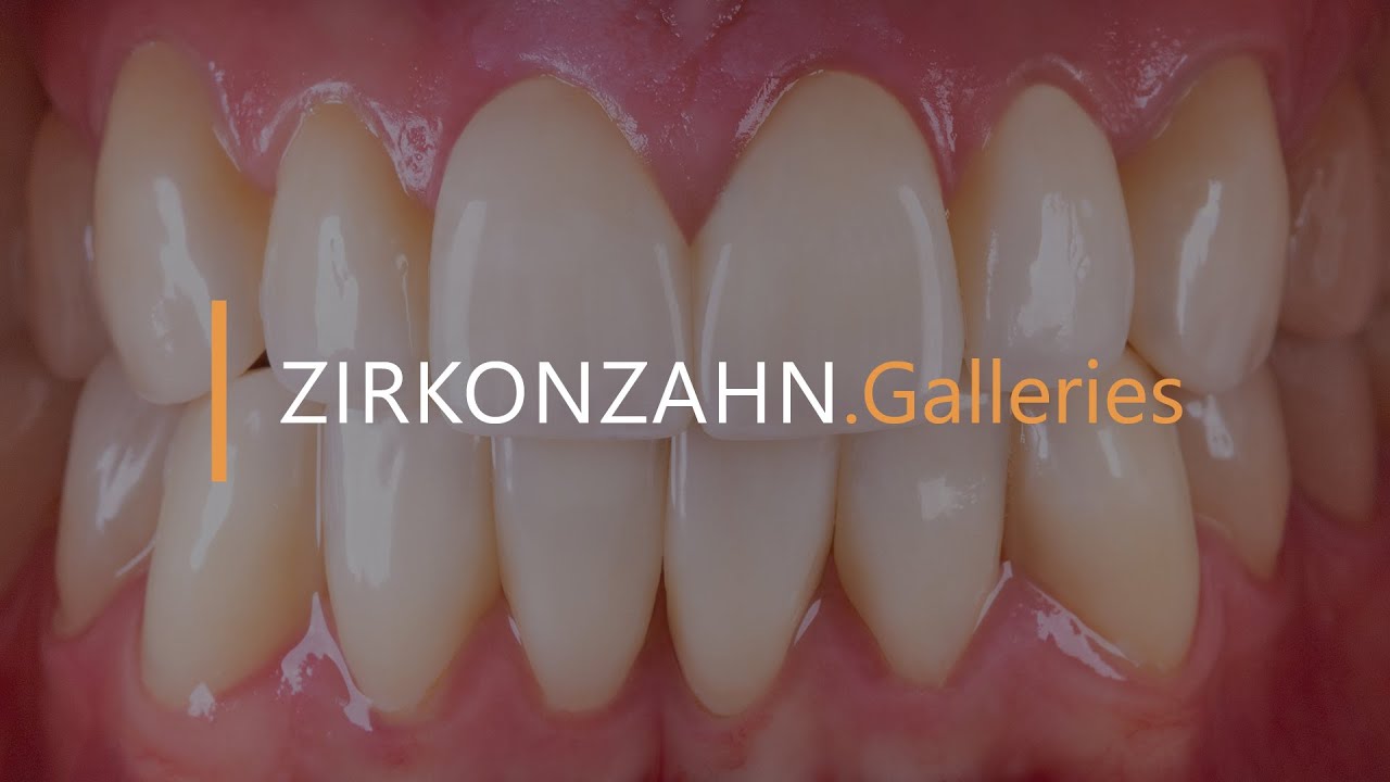 Minimally invasive restoration with ultra-thin zirconia veneers ...