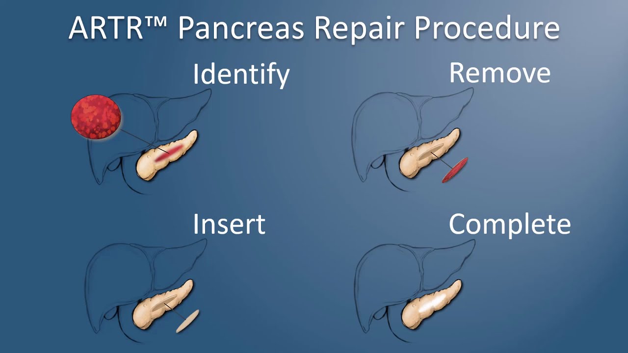 Pancreas Repair Procedure by BCM Industries - YouTube