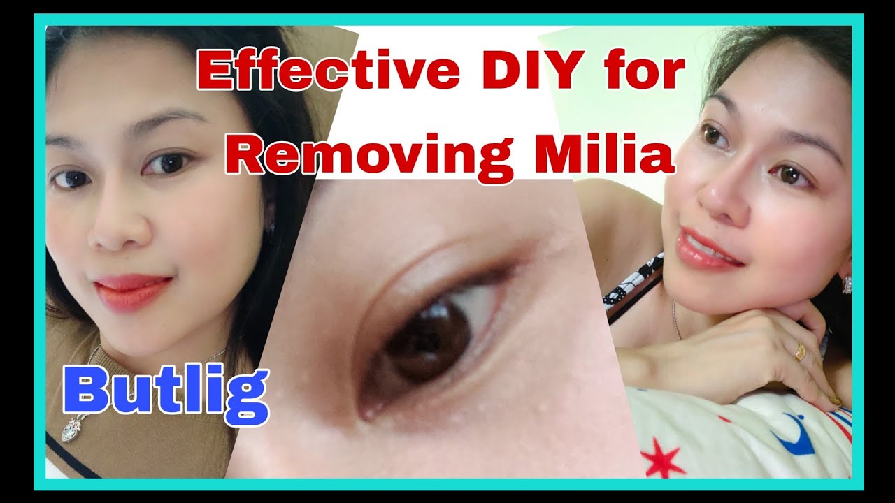 How to remove Face Milia at Home / DIY Home Remedies for Milia - YouTube