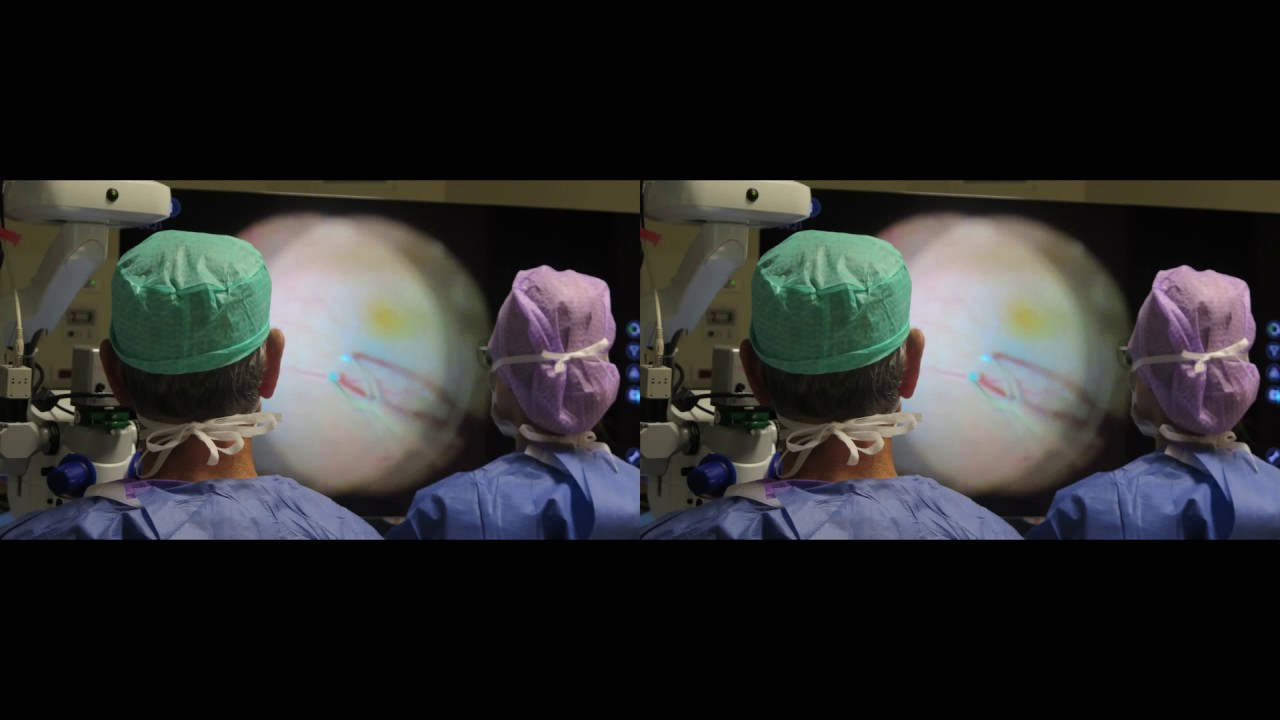 3D cataract surgery phakoemulsification - YouTube