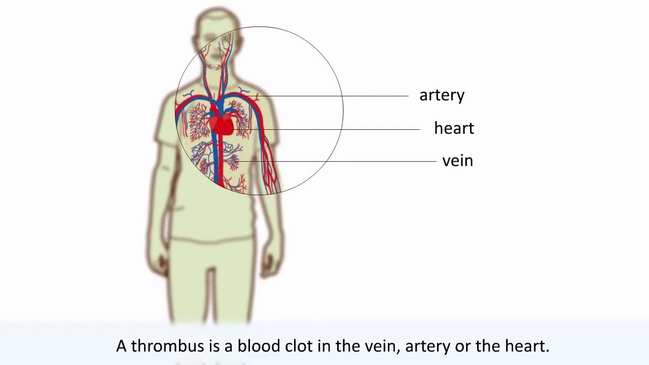 Thrombosis - What is it and how is it treated? | Health Animation ...