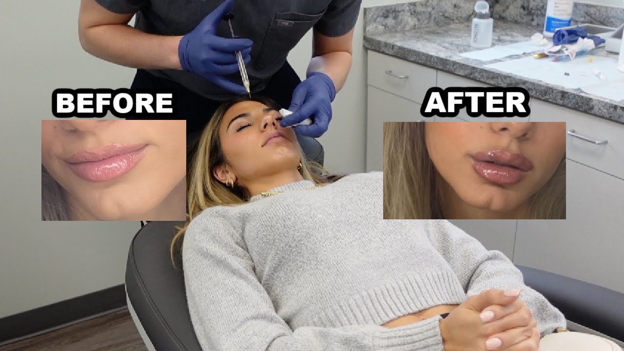 GETTING LIP FILLER AND BOTOX FOR THE FIRST TIME! - YouTube