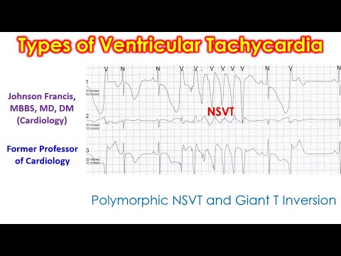 Ventricular Tachycardia 370+ Ventricular Tachycardia Stock Photos,