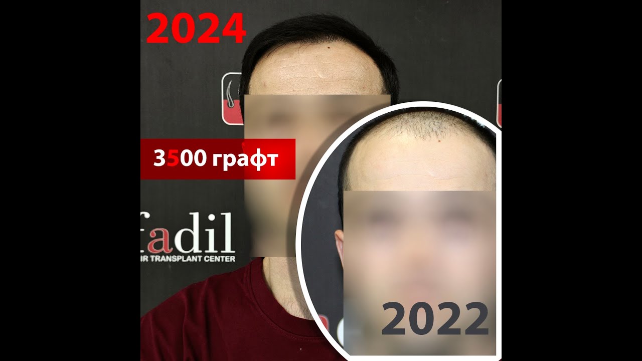 3500 графт Спустя 2 года | Soch ekish natijasi 2 yildan so'ng - YouTube