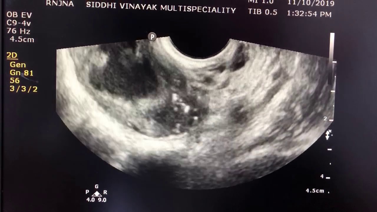 Pyosalpinx ultrasound sonography - YouTube