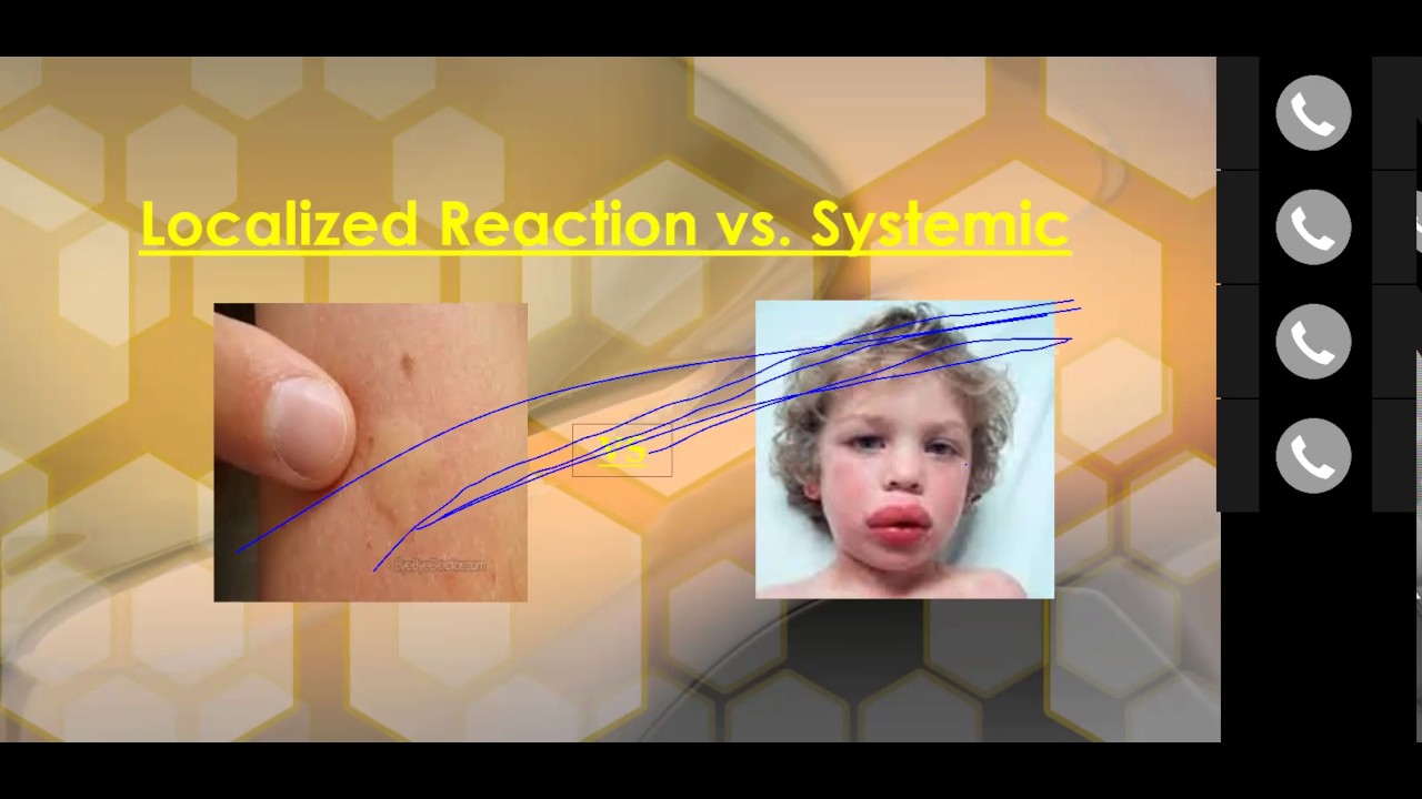 EMS Webinar, "Pediatric Allergic Reactions" - YouTube