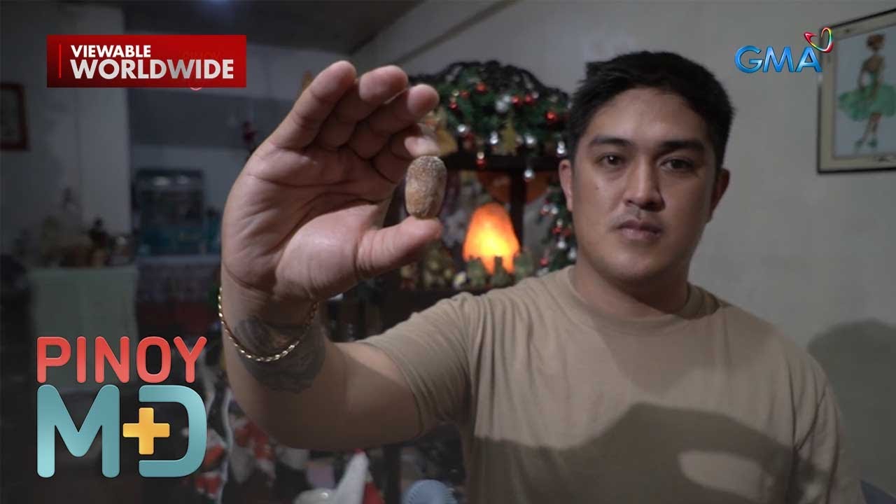 Pagkakaroon ng bato sa apdo, ano ang posibleng sanhi? | Pinoy MD - YouTube