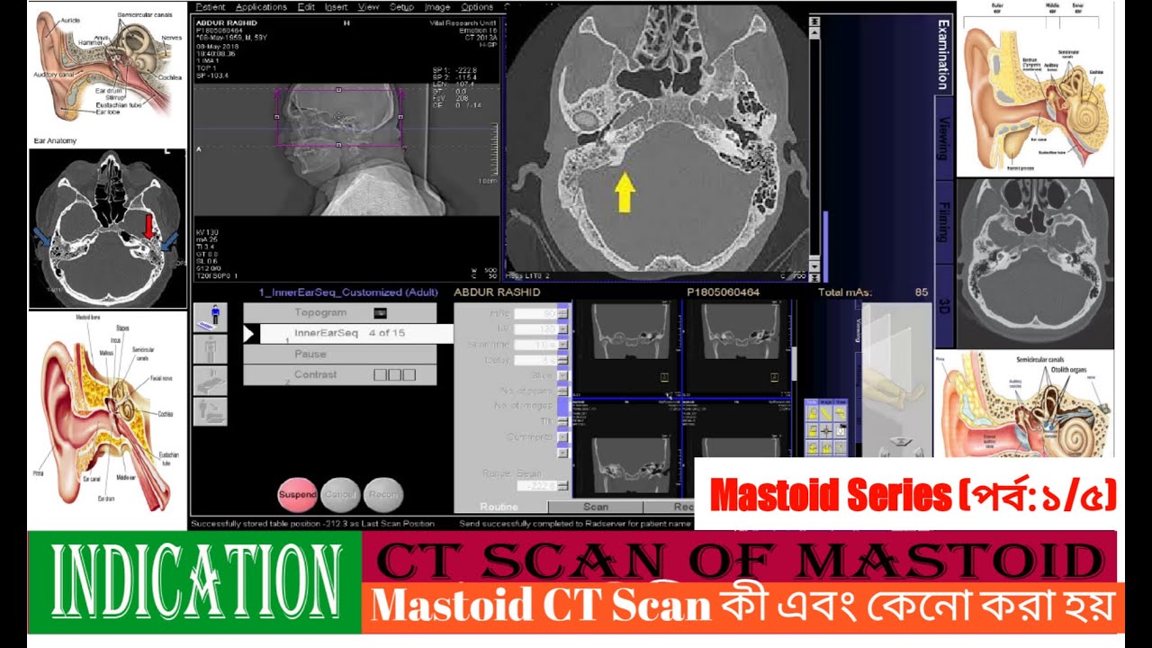 Video No:014. Mastid Series: 1 of 5. Mastoid CT Scan কী এবং কেনো করা ...