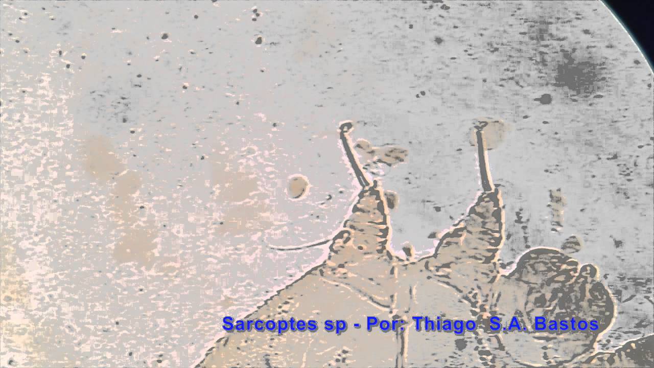 Sarcoptes Sp Youtube