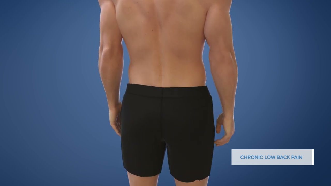Intracept Procedure for Chronic Low Back Pain - YouTube