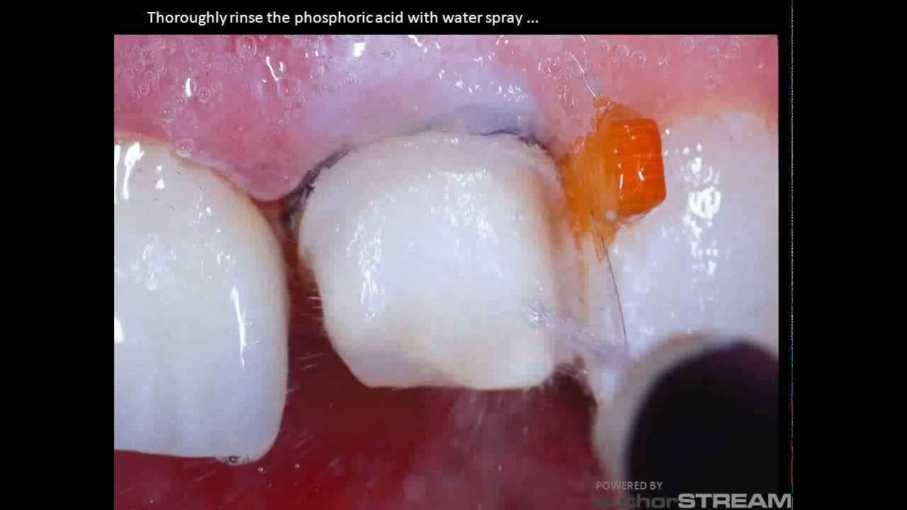 Variolink II wz Excite DSC - YouTube