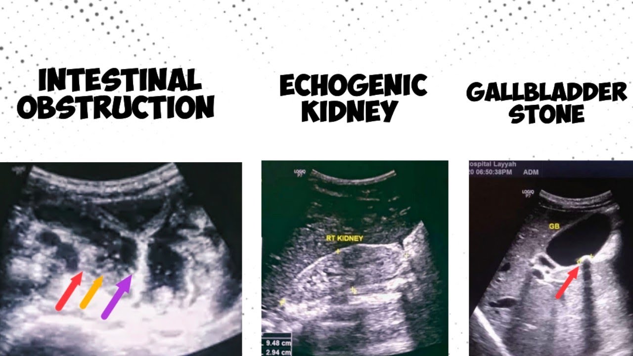 How to: Ultrasound video showing Intestinal Obstruction + Acute Renal ...