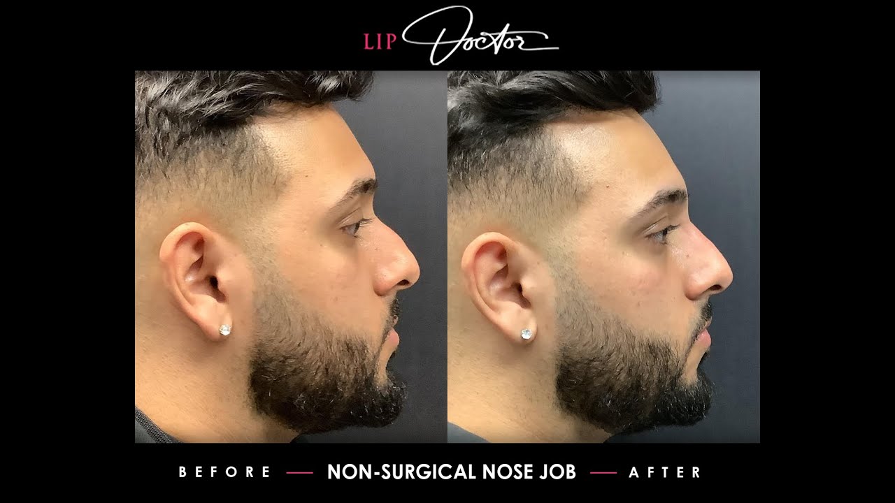 15-Minute Non-Surgical Nose Job Transformation | Dr. Bector at Lip ...