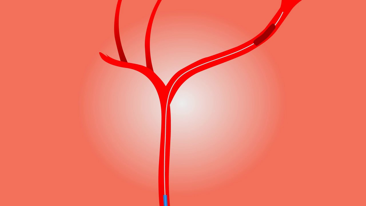 brain ischemic stroke blood clot animation health medical free video ...