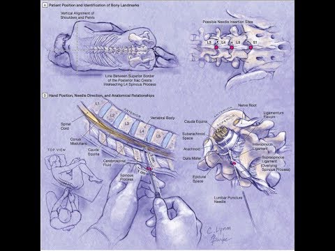 Lumbar Puncture and Cerebrospinal Fluid in children - YouTube