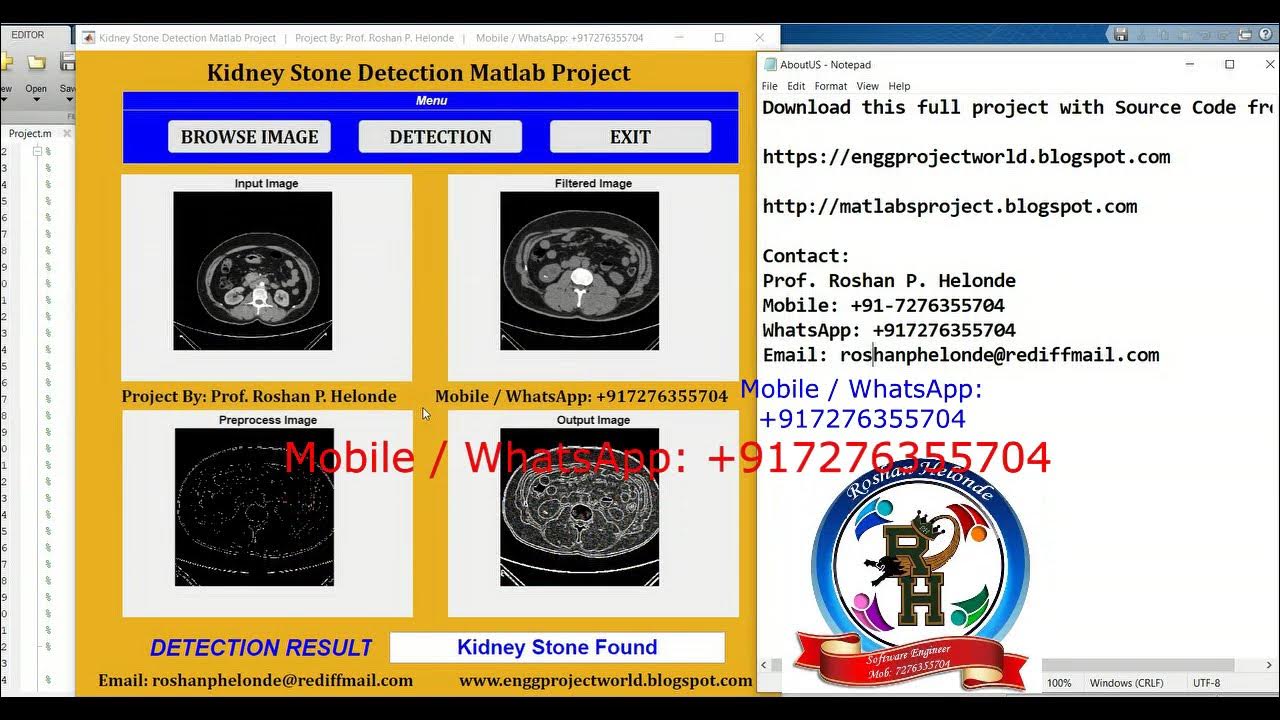 Kidney Stone Detection Using Matlab | Kidney Stone Classification Using Image Processing ...