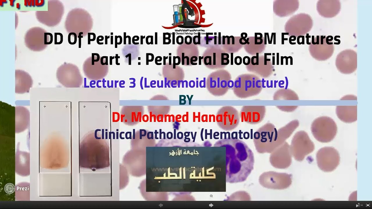 Part1 : Peripheral Blood Film /Lecture 3: Leukemoid blood picture - YouTube