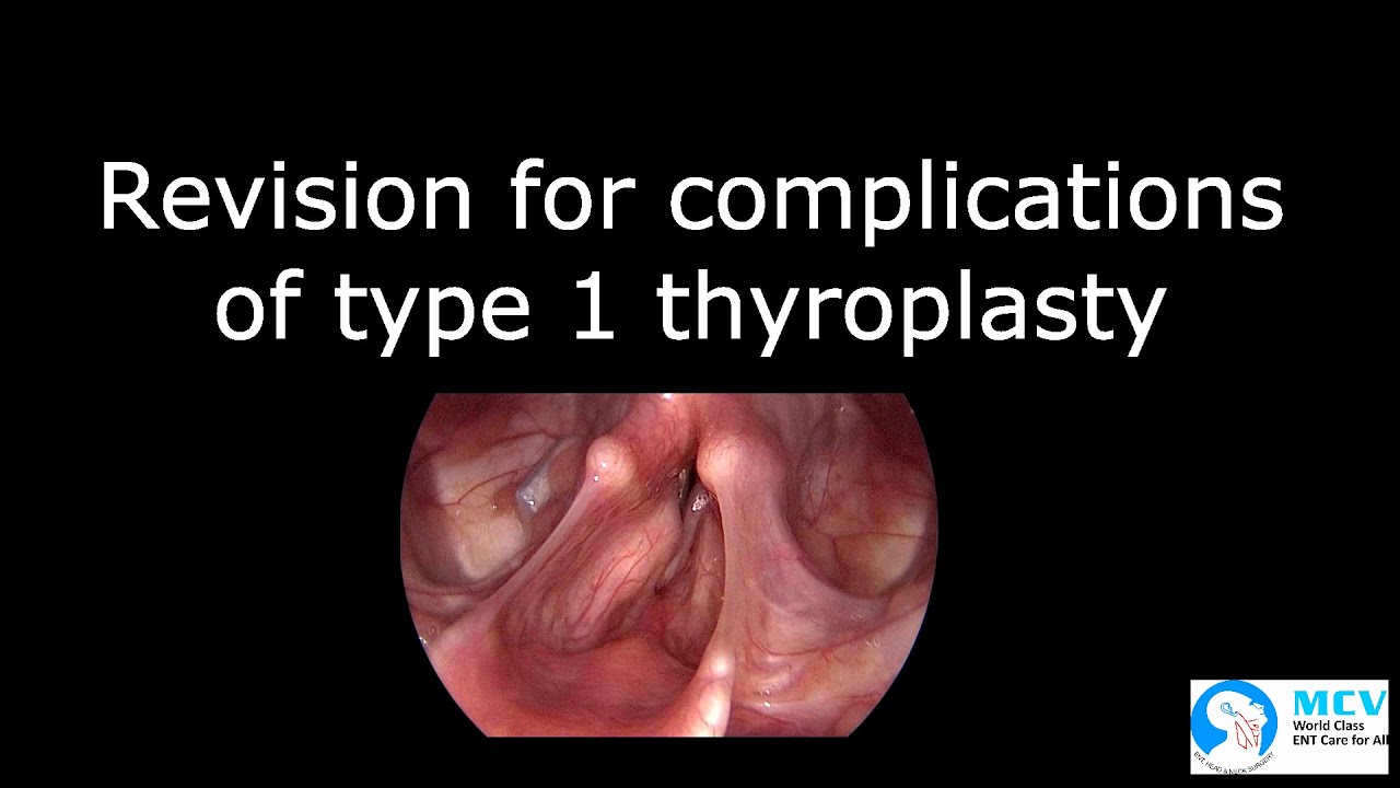 Revision for complications of type 1 Thyroplasty - YouTube