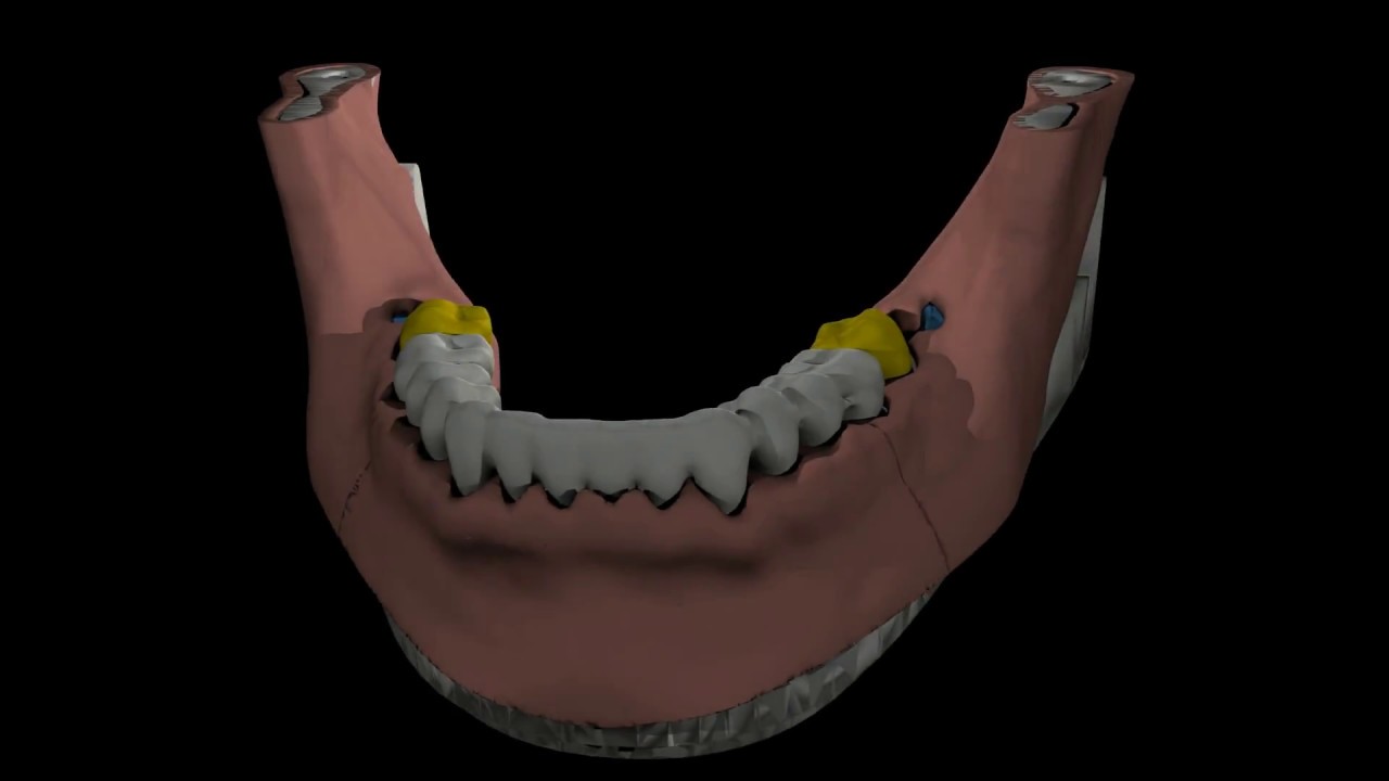 Animation - Impacted Third Molar 3D Model - YouTube