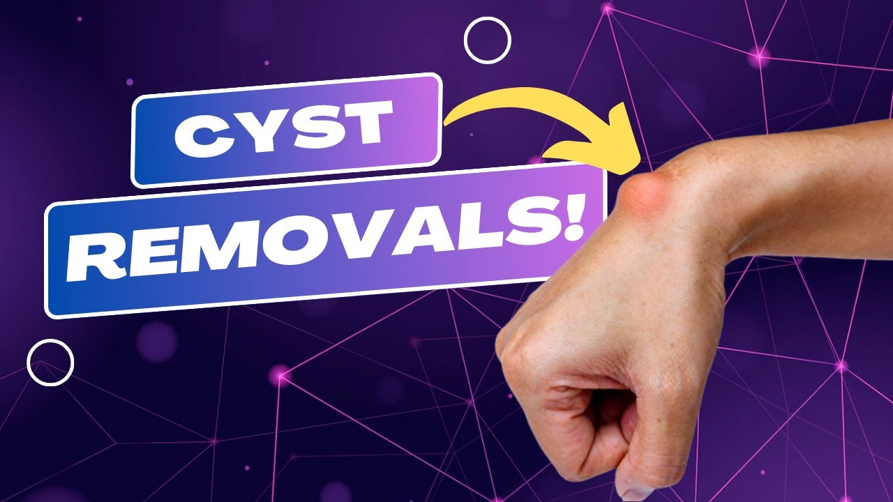 Cyst Removal: Upper Back | Progressive Health Services. - YouTube